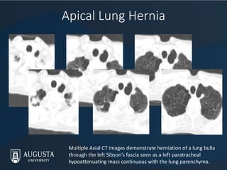 Interesting cases of lung hernias | PPTX
