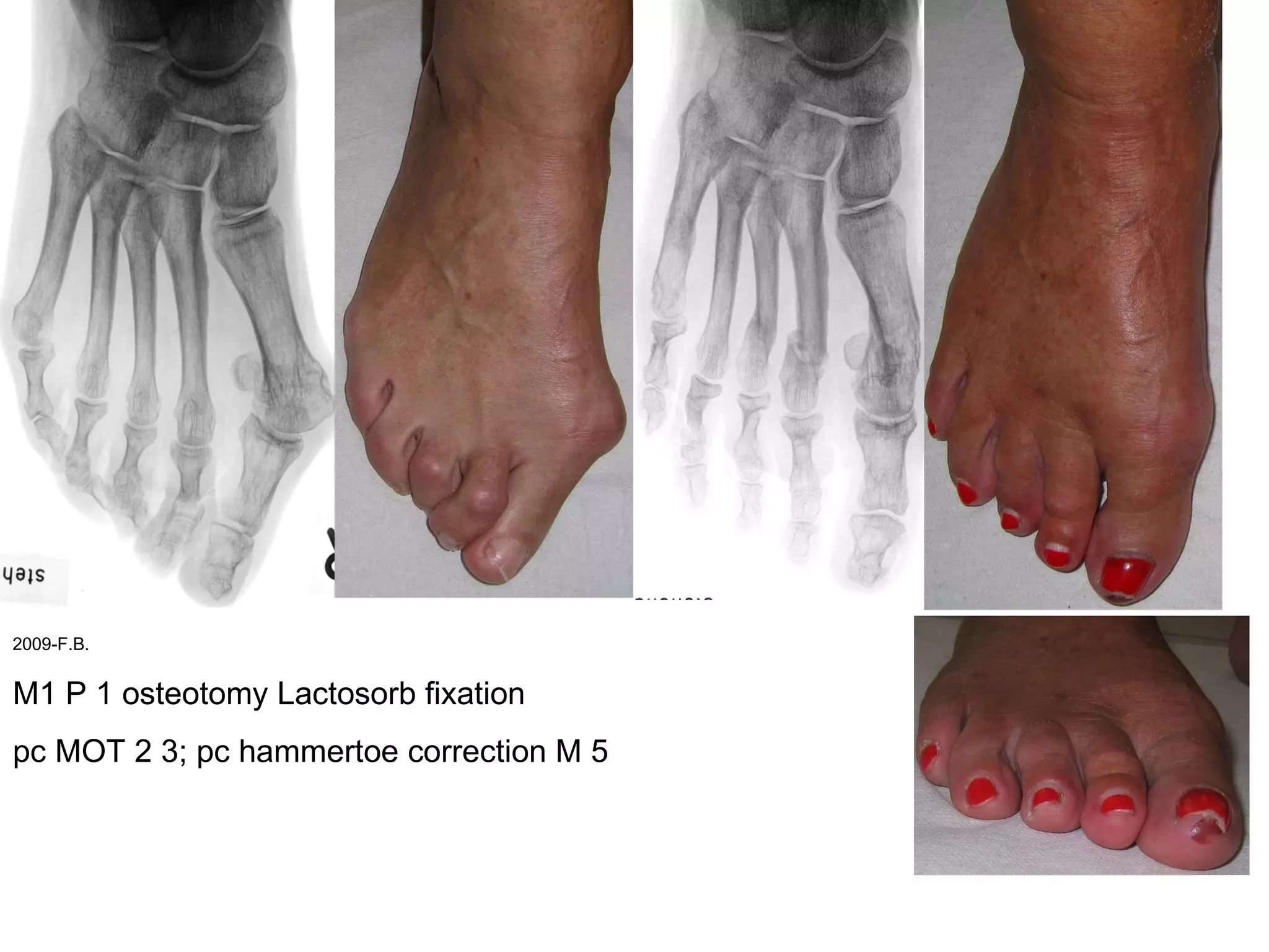 Pedographic and Clinical Results of Percutaneous Metatarsal Osteotomies ...