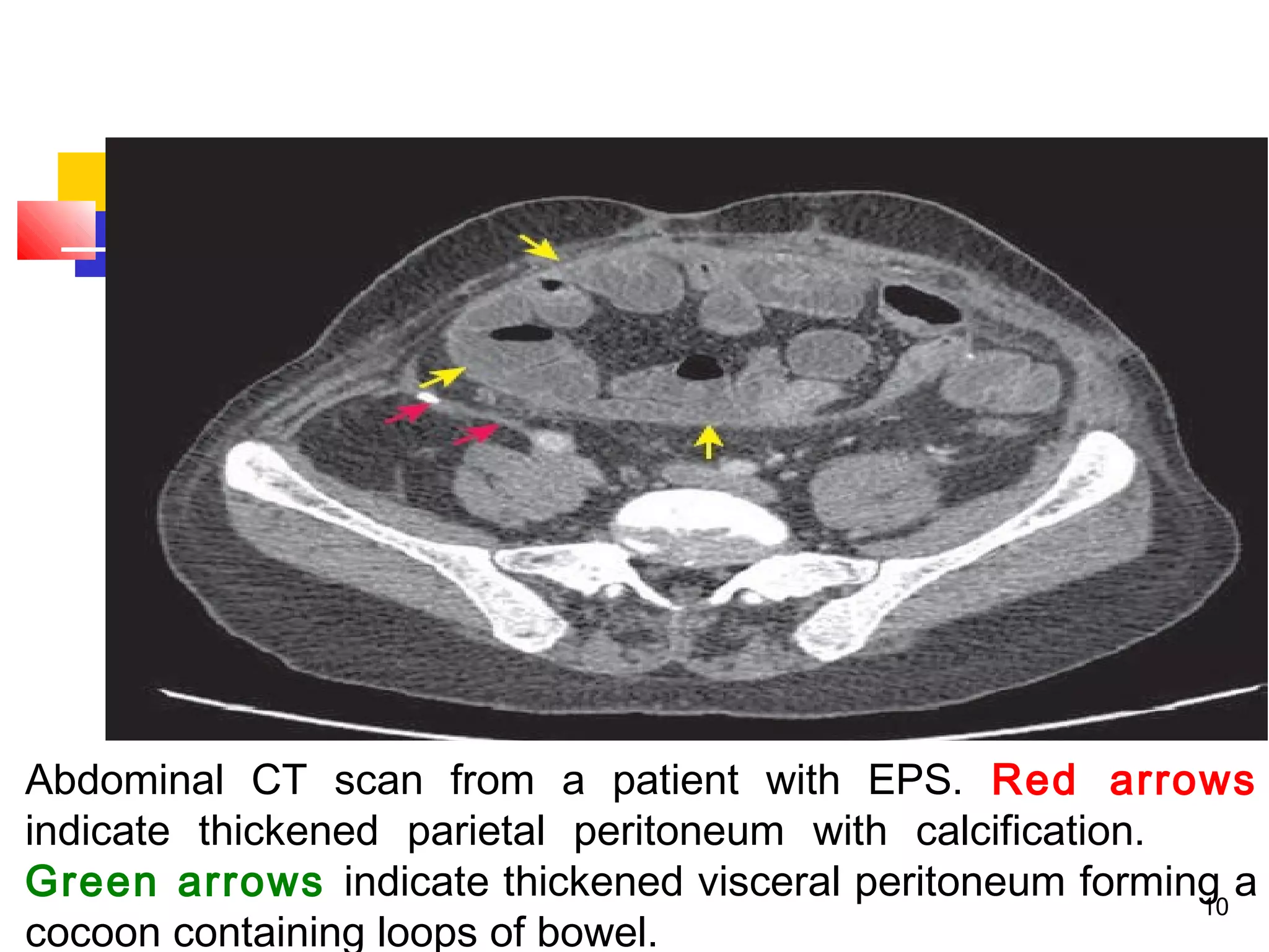 ENCAPSULATING PERITONEAL SCLEROSIS (EPS) | PPT