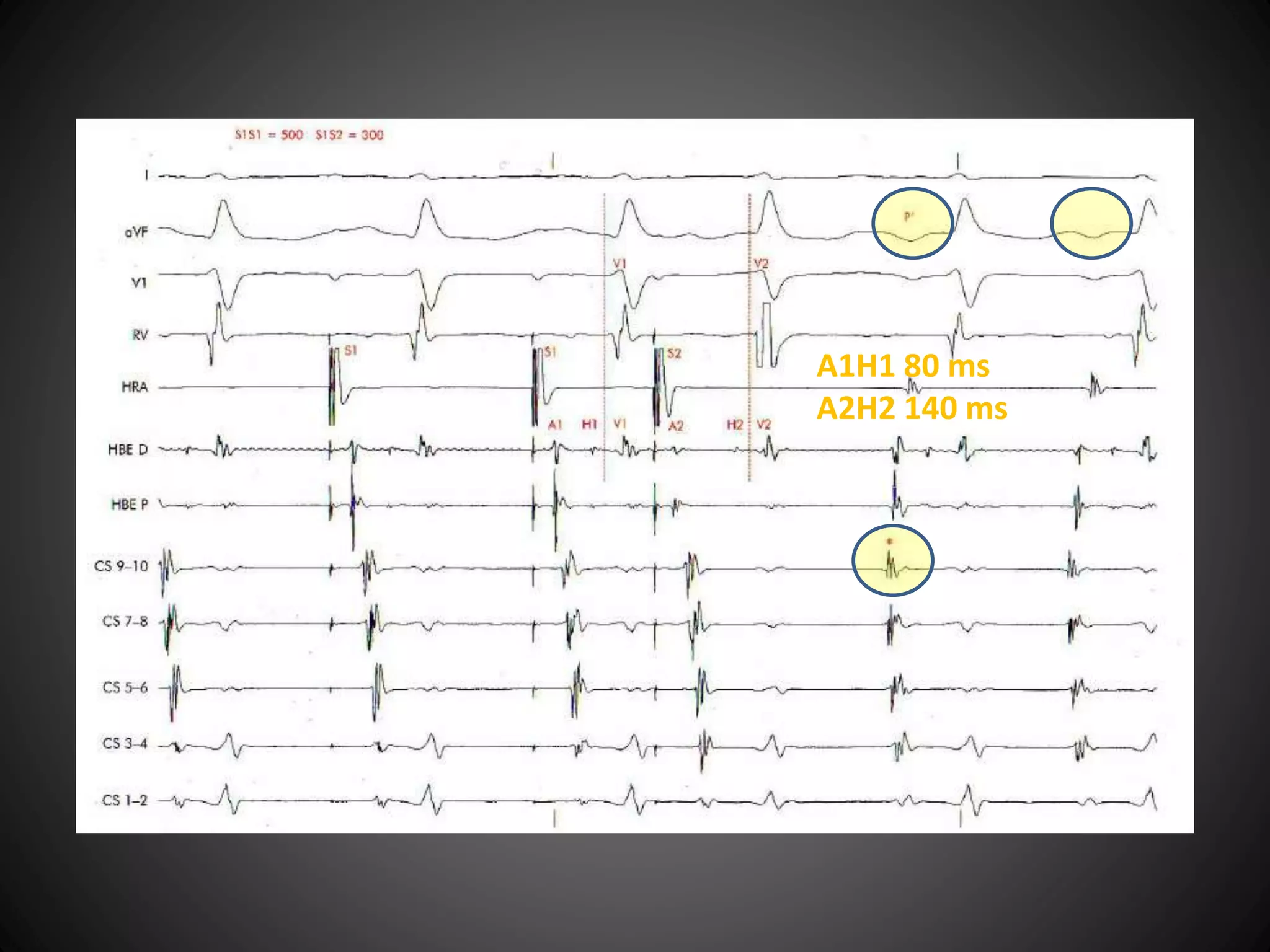 Electrophysiology study protocol | PPTX