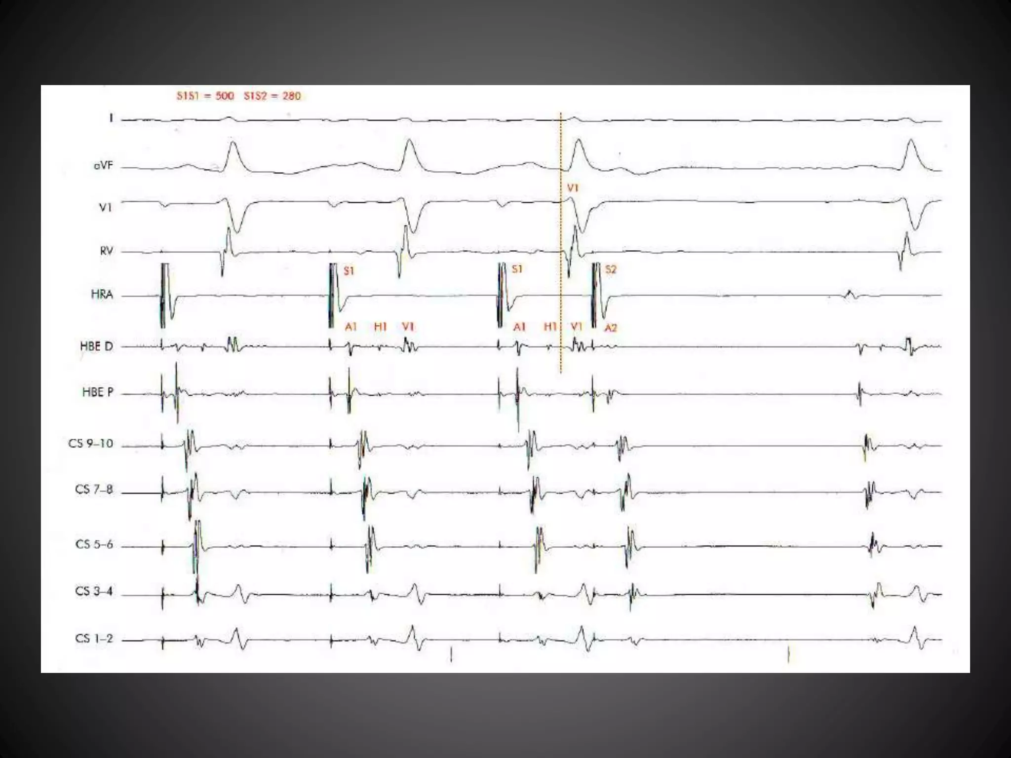 Electrophysiology study protocol | PPTX