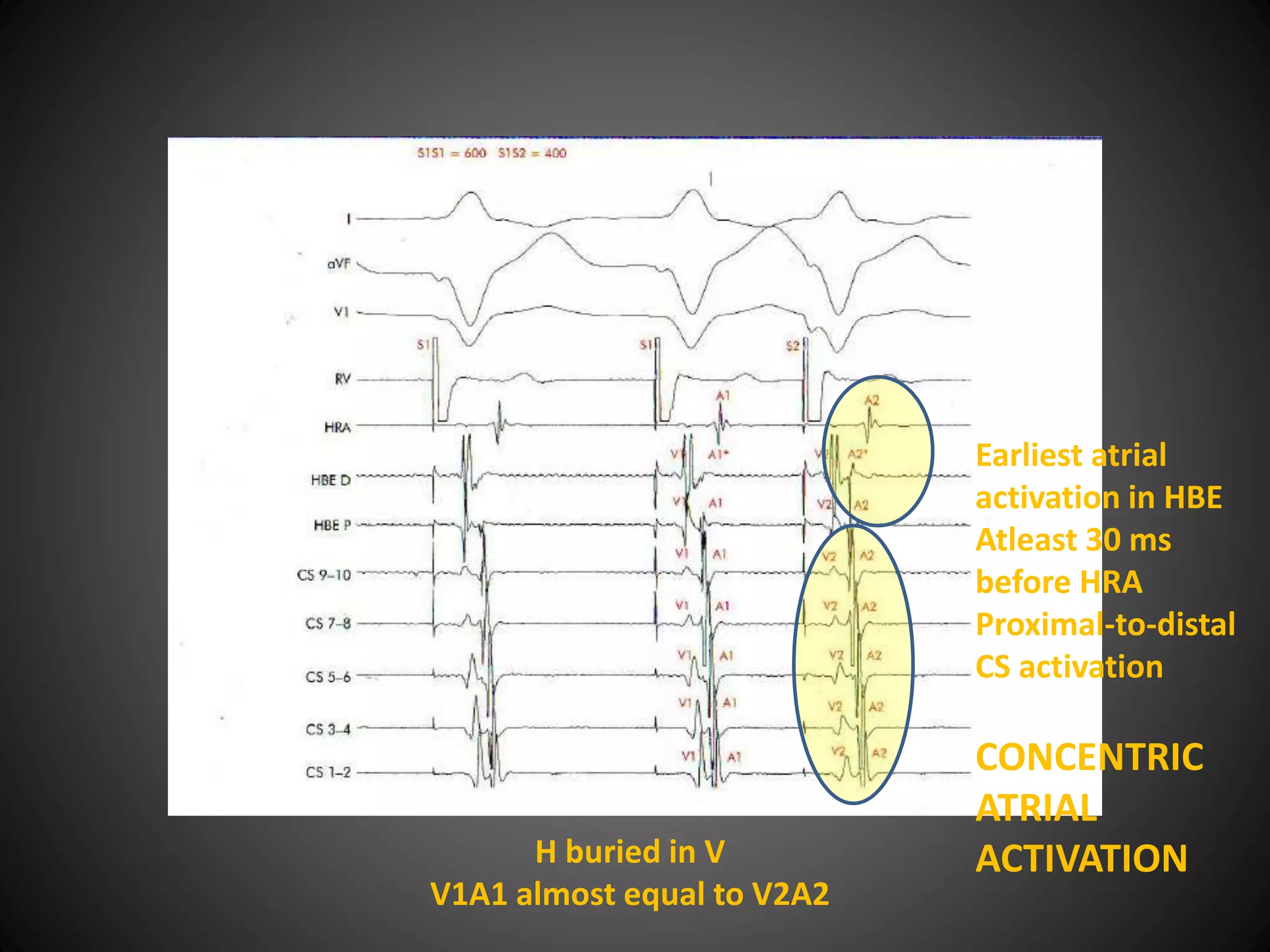Electrophysiology study protocol | PPTX