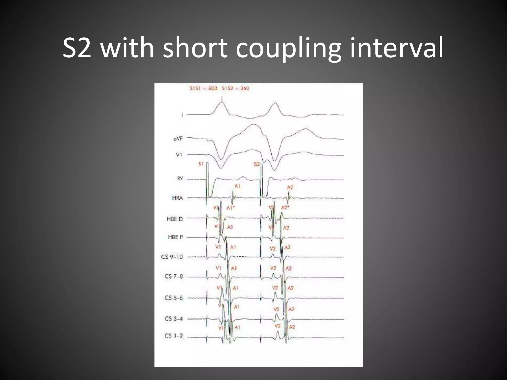 Electrophysiology study protocol | PPTX