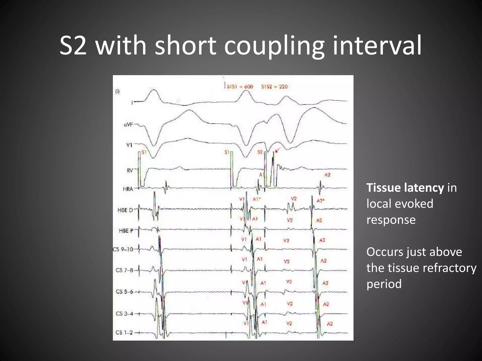 Electrophysiology study protocol | PPTX