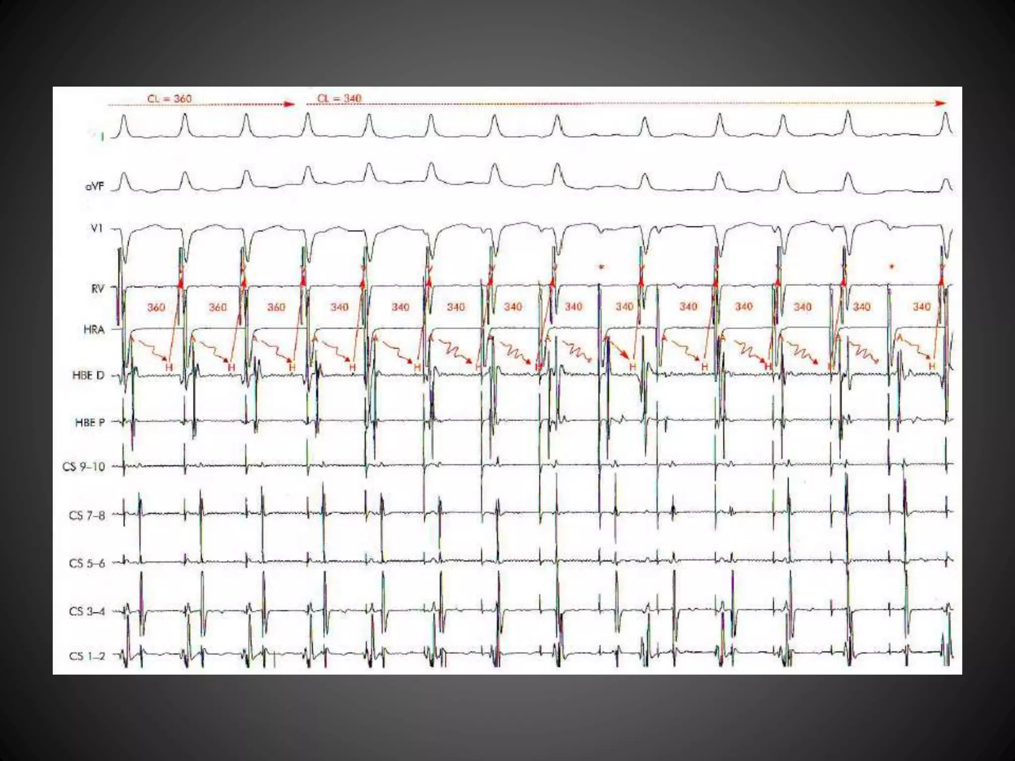 Electrophysiology study protocol | PPTX | Heart and Cardiovascular ...