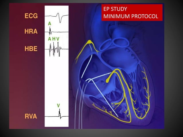Electrophysiology study protocol | PPTX | Heart and Cardiovascular ...