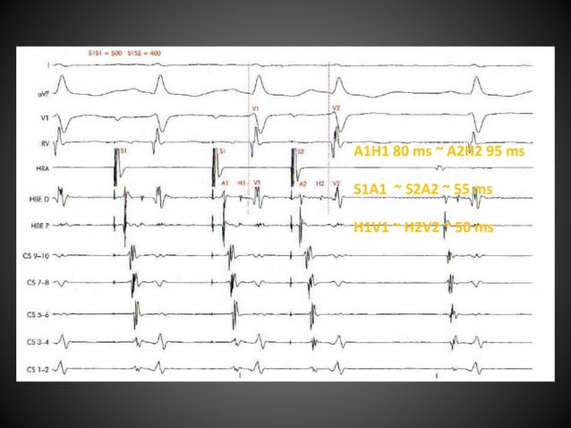 Electrophysiology study protocol | PPTX | Heart and Cardiovascular ...