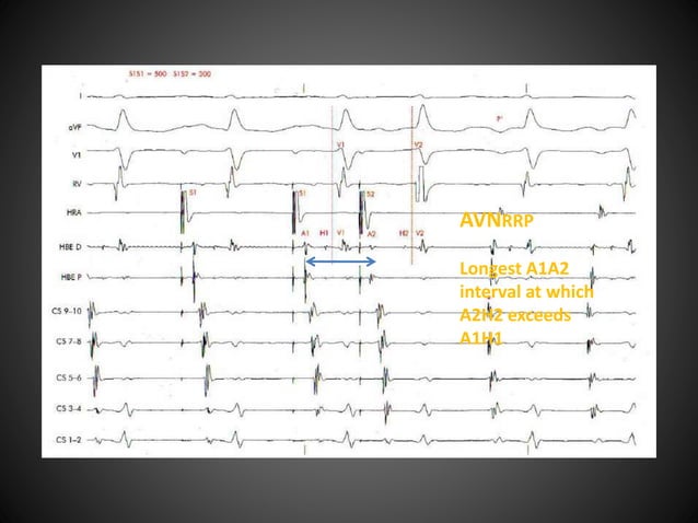 Electrophysiology study protocol | PPTX | Heart and Cardiovascular ...