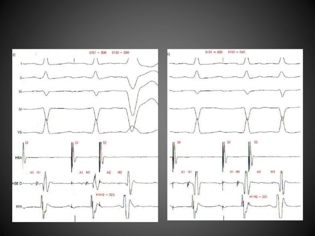 Electrophysiology study protocol | PPTX | Heart and Cardiovascular ...