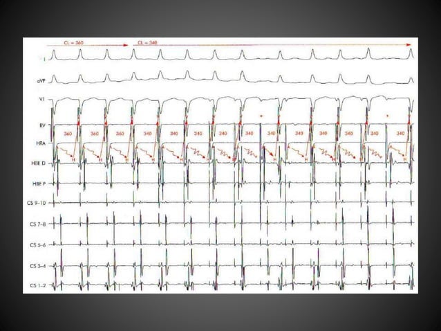 Electrophysiology study protocol | PPTX | Heart and Cardiovascular ...