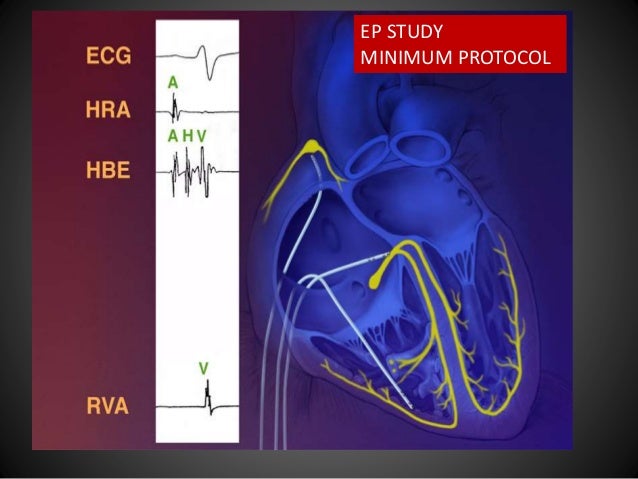 Electrophysiology study protocol