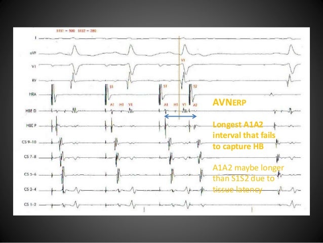 Electrophysiology study protocol