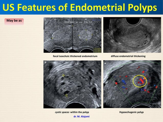 Endometrial Polyps 2021 dr.ajami | PDF | Reproductive Health | Diseases ...