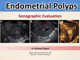 Uterine Polyps Ultrasound