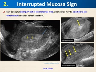 Endometrial Polyps 2021 dr.ajami | PPT
