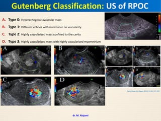 Endometrial Polyps 2021 dr.ajami | PPT
