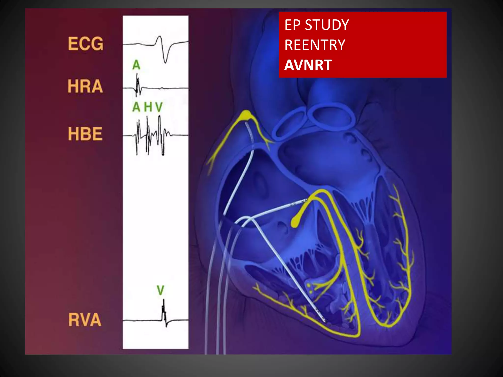 Electrophysiology AVNRT | PPTX