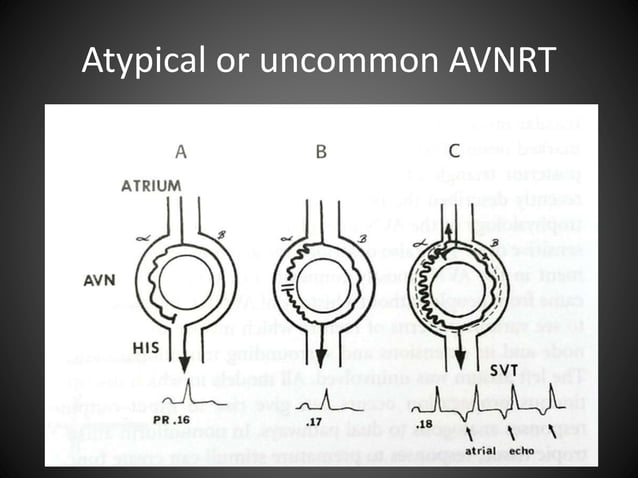 Electrophysiology AVNRT | PPTX