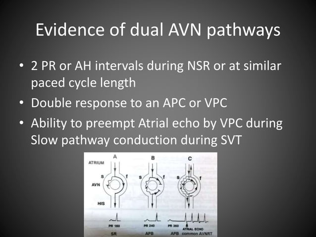Electrophysiology AVNRT | PPTX