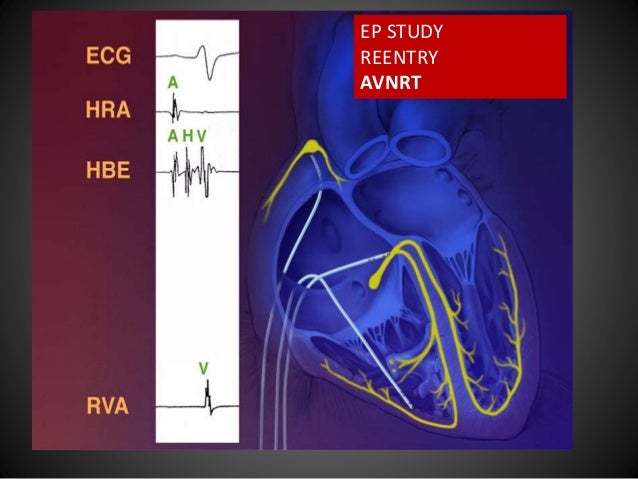 Electrophysiology AVNRT