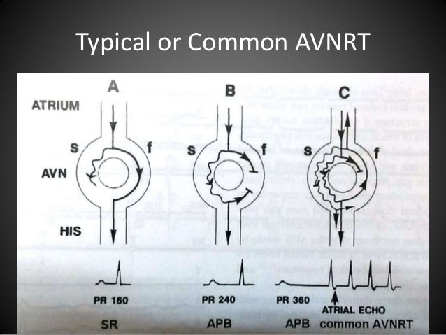 Electrophysiology AVNRT