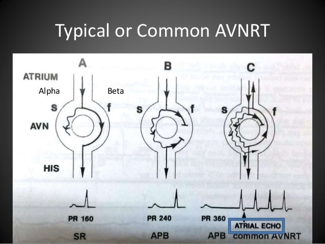 Electrophysiology AVNRT