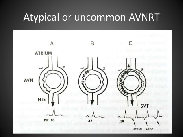 Electrophysiology AVNRT