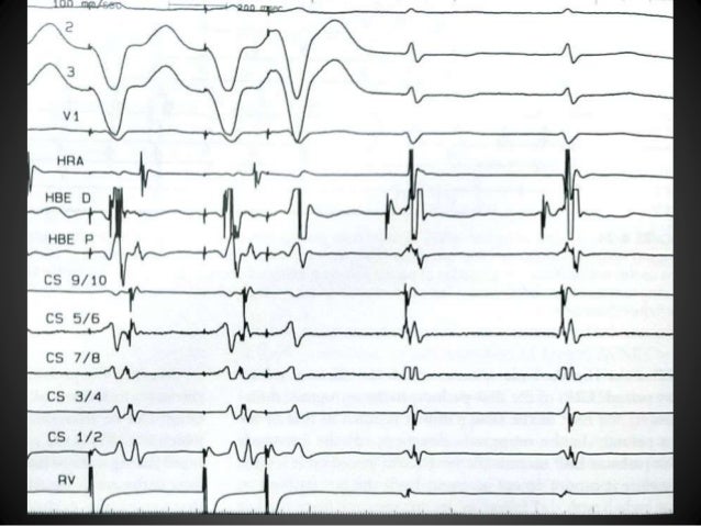 Electrophysiology AVNRT