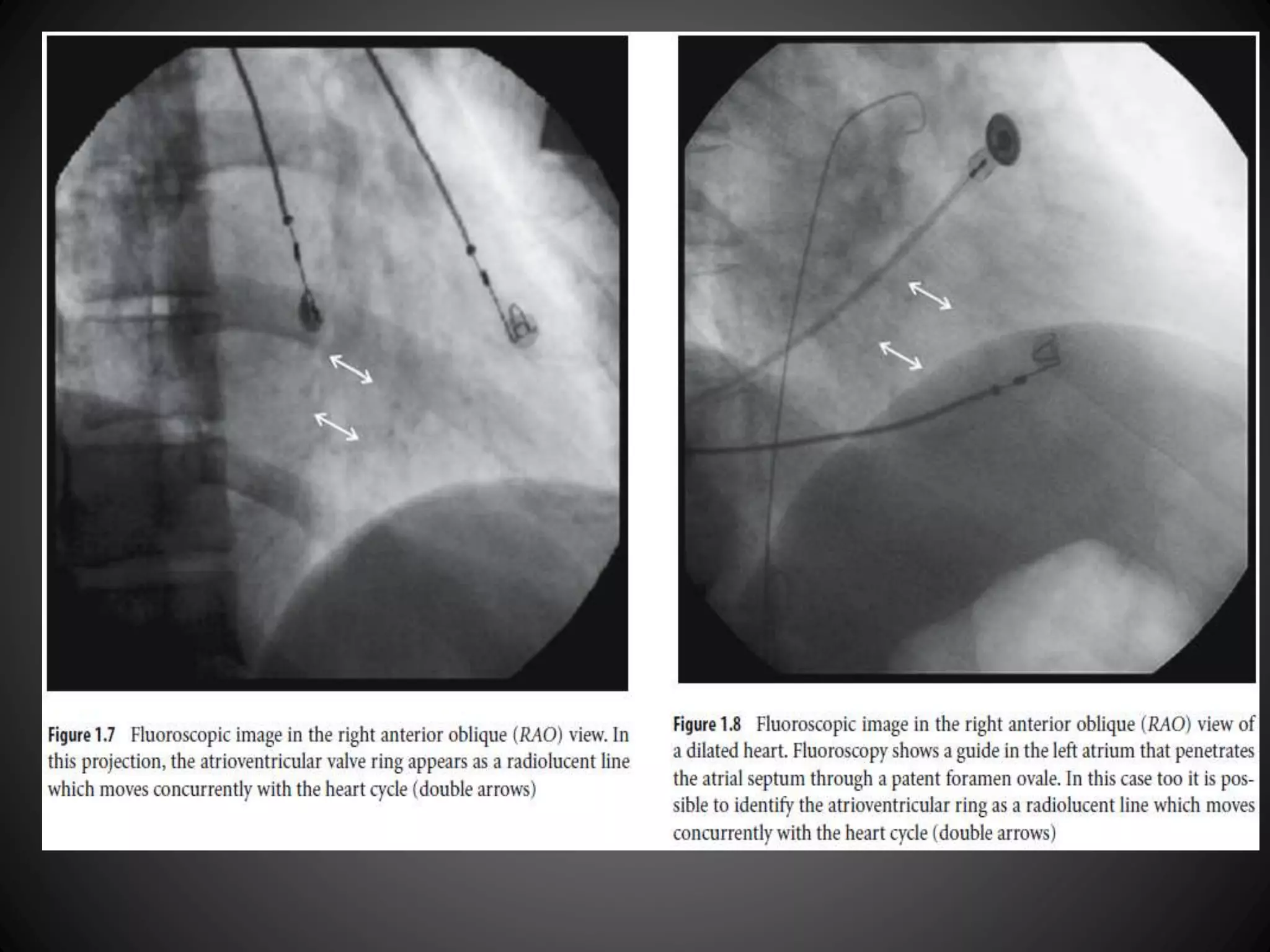 Electrophysiology study basics | PPTX