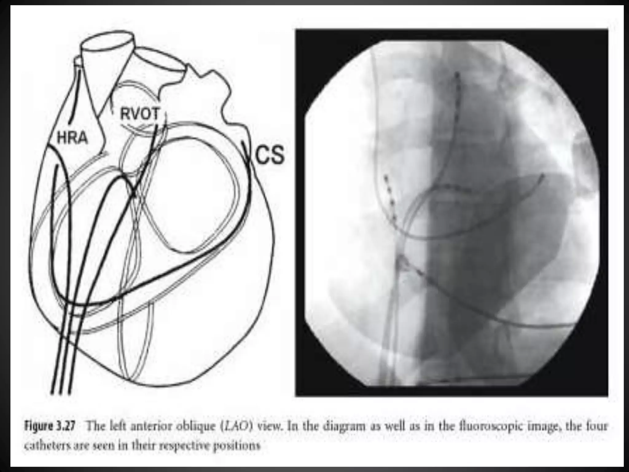 Electrophysiology study basics | PPTX