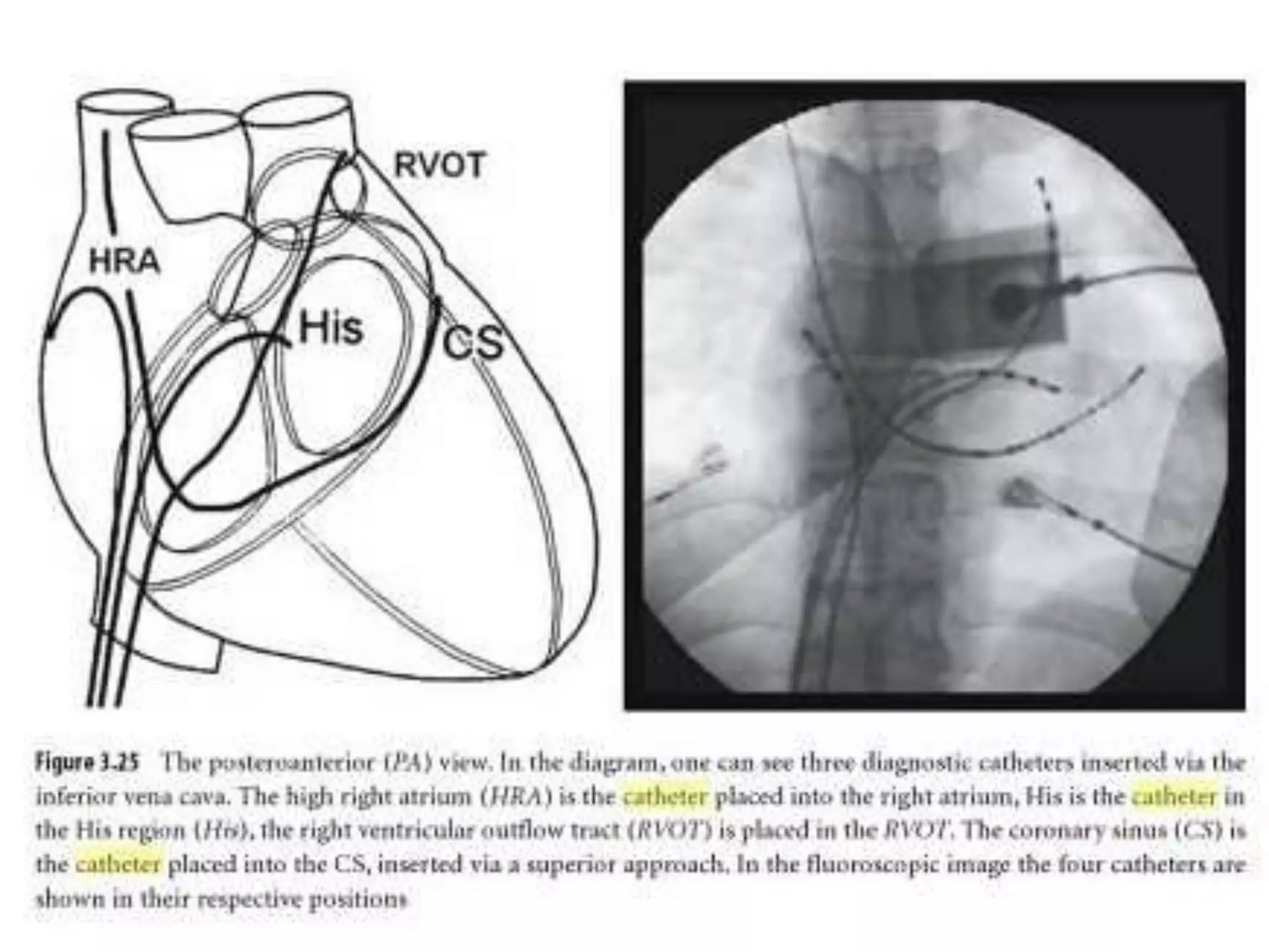 Electrophysiology study basics | PPTX