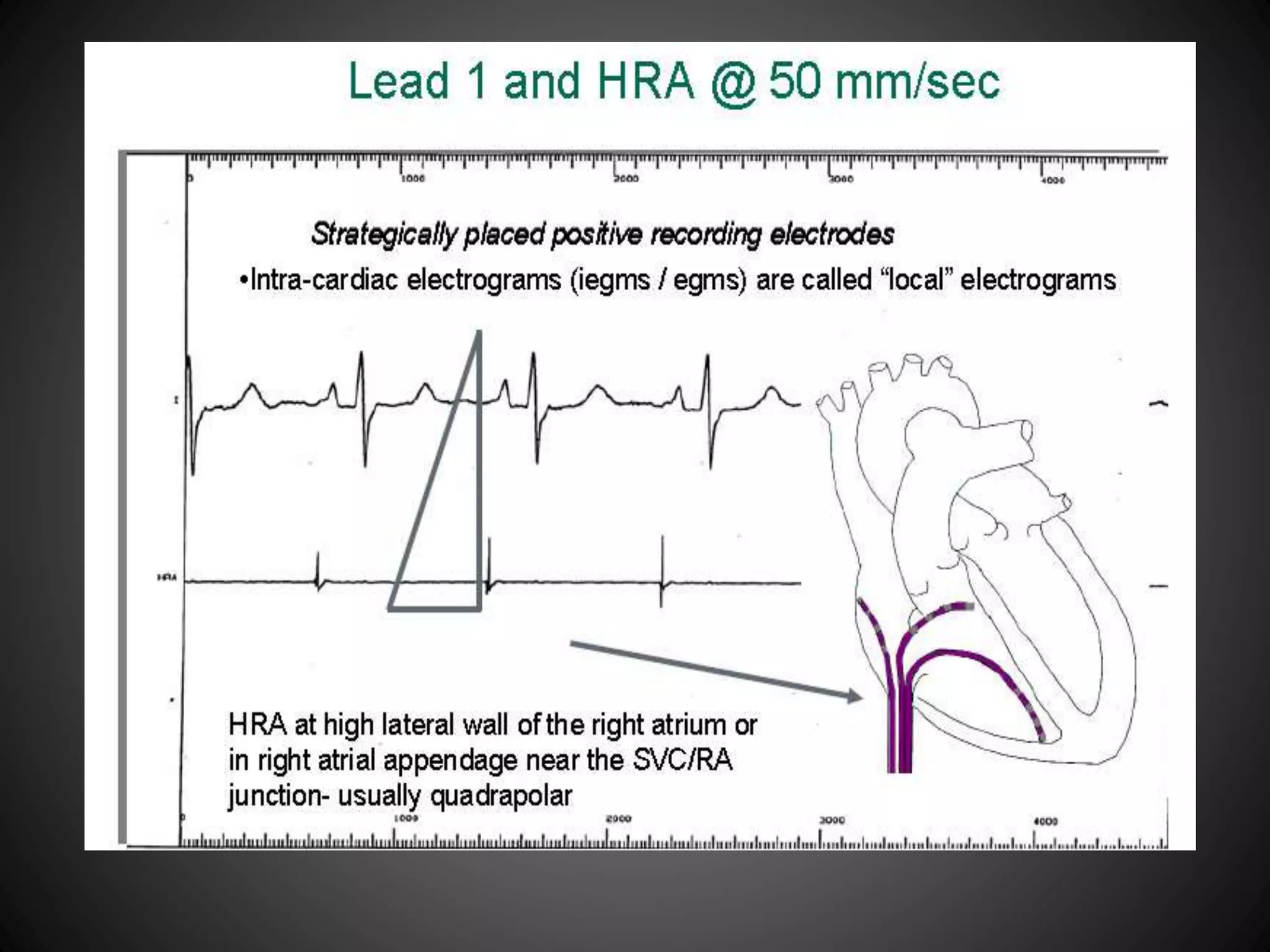 Electrophysiology study basics | PPTX
