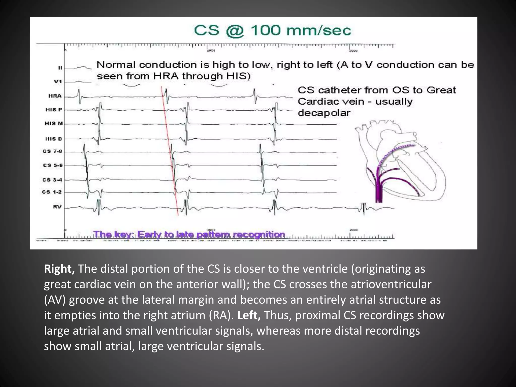 Electrophysiology study basics | PPTX