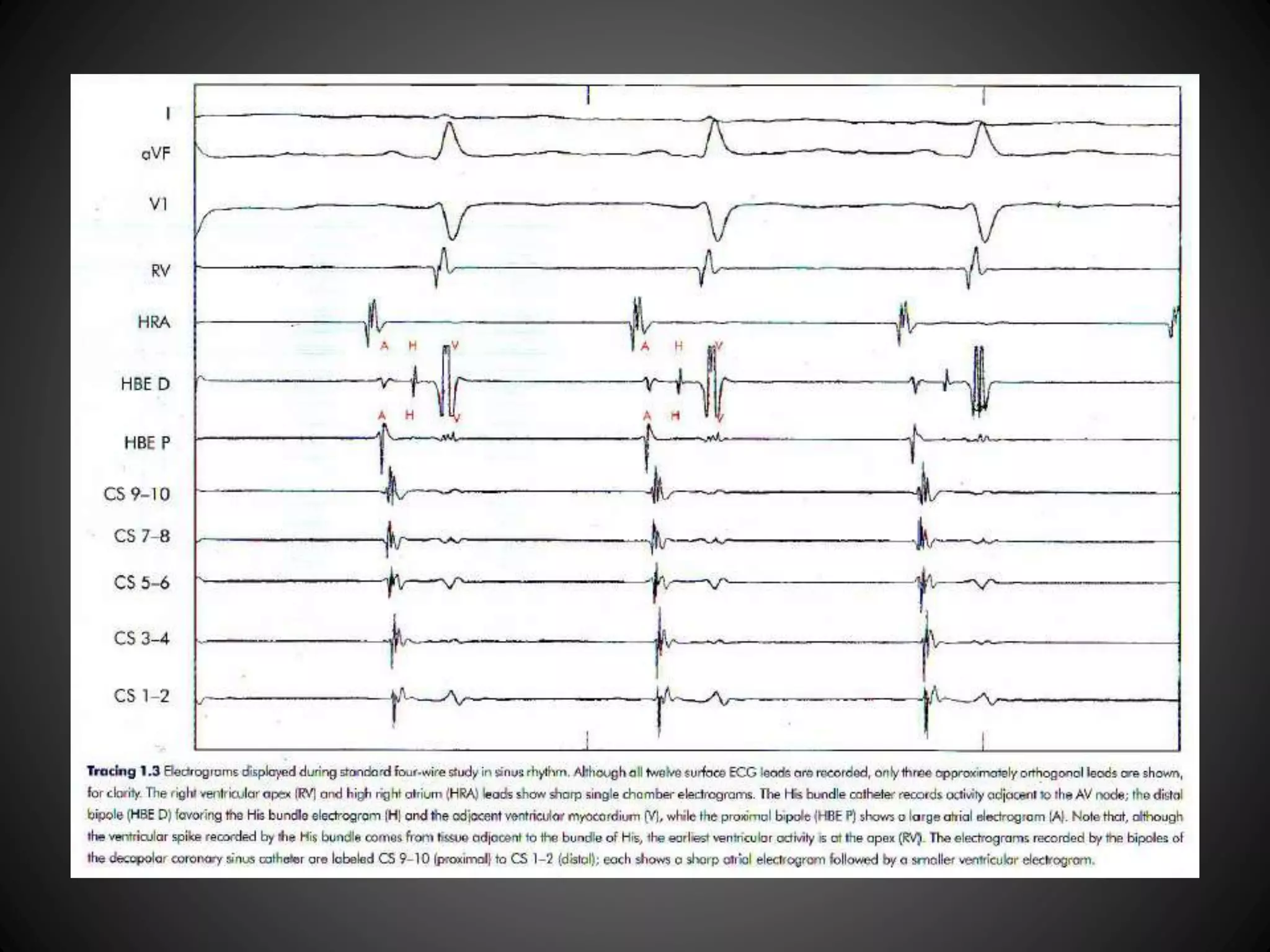 Electrophysiology study basics | PPTX