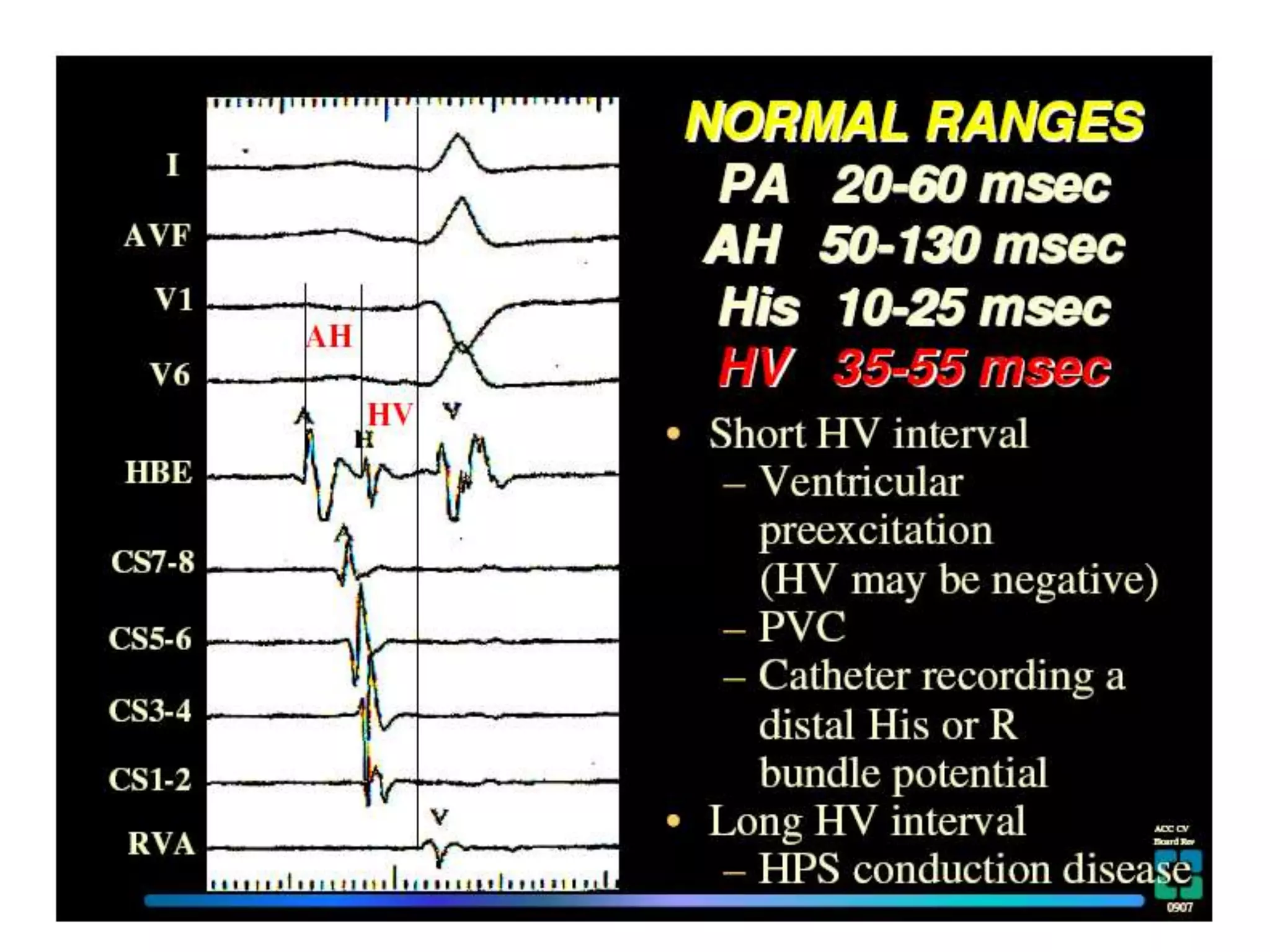 Electrophysiology study basics | PPTX