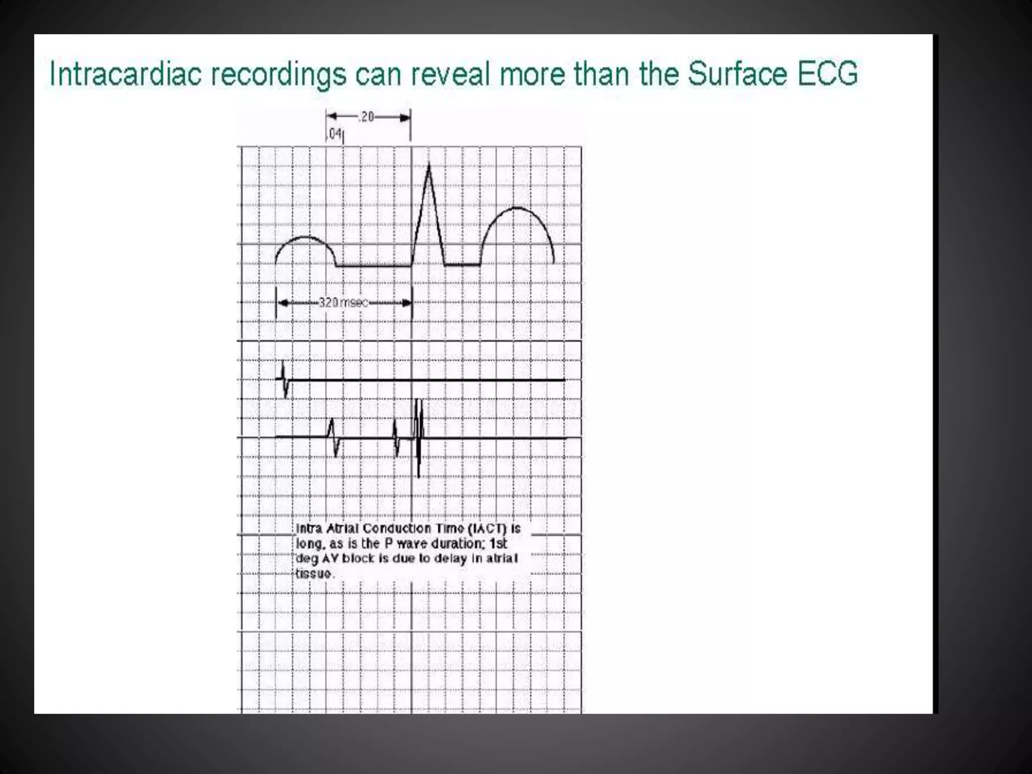 Electrophysiology study basics | PPTX