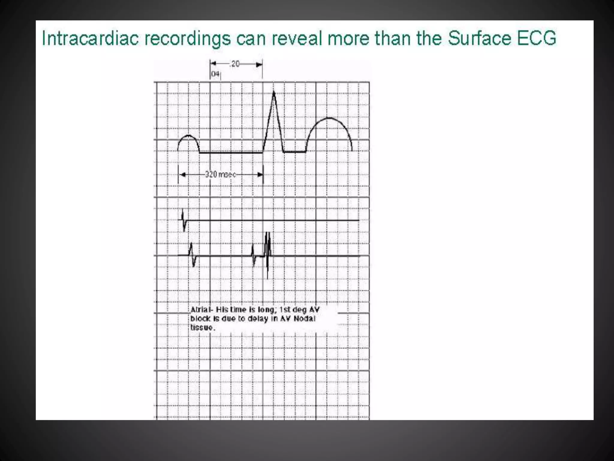Electrophysiology study basics | PPTX