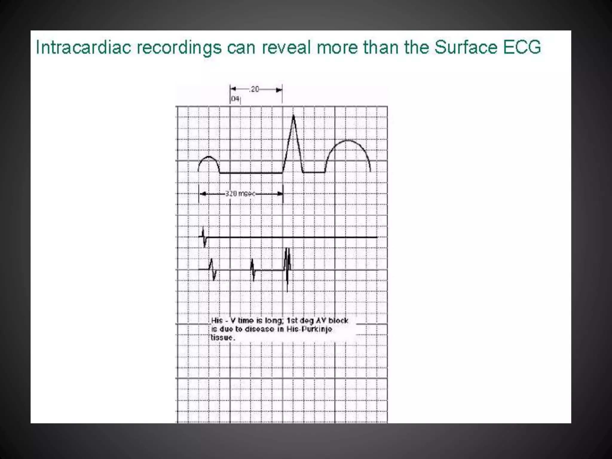 Electrophysiology study basics | PPTX