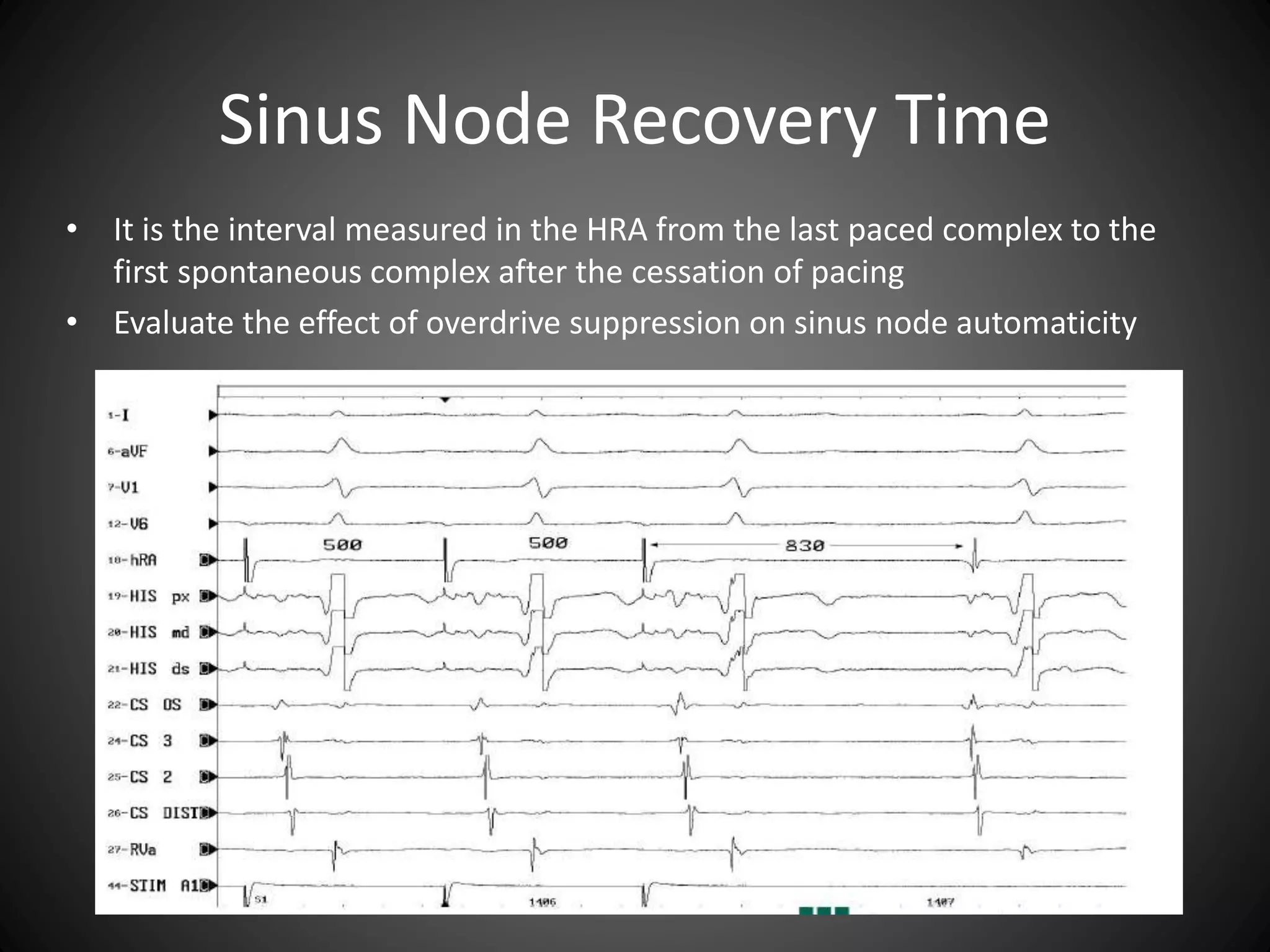 Electrophysiology study basics | PPTX