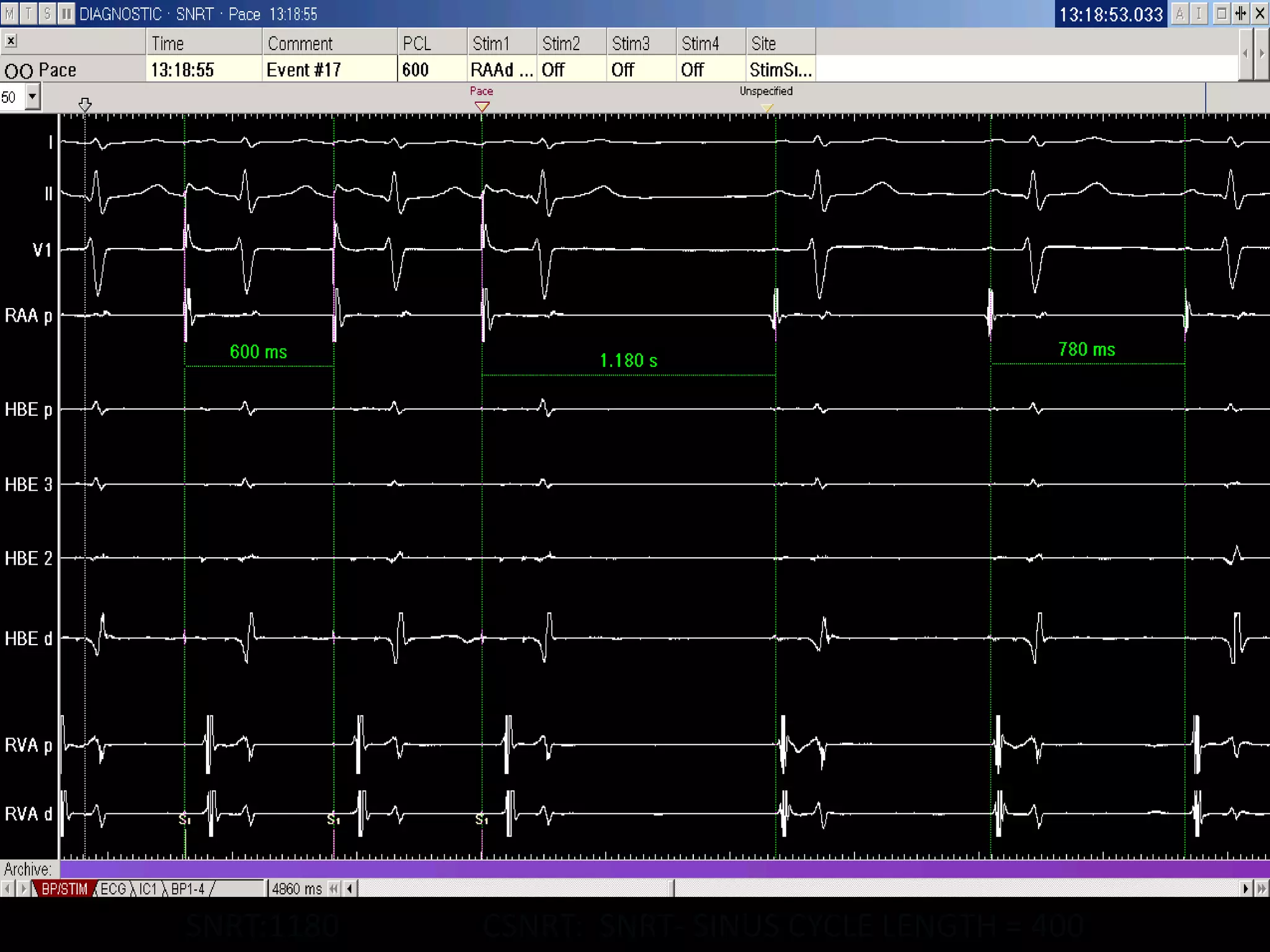 Electrophysiology study basics | PPTX