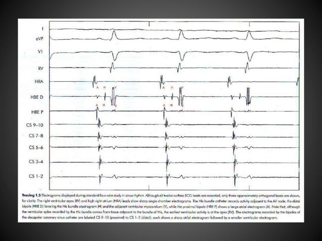 Electrophysiology study basics | PPTX