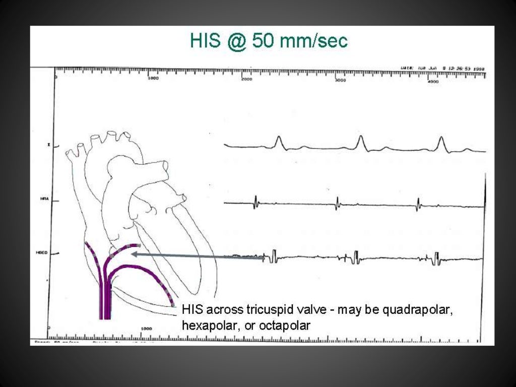 Electrophysiology study basics
