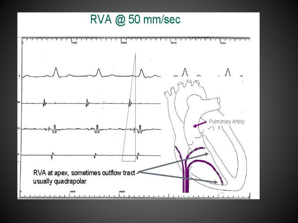 Electrophysiology study basics