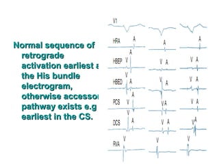 Electrophysiologic basis part3 | PPT
