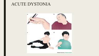 Clinical teaching on Management of extra pyramidal symptoms ...