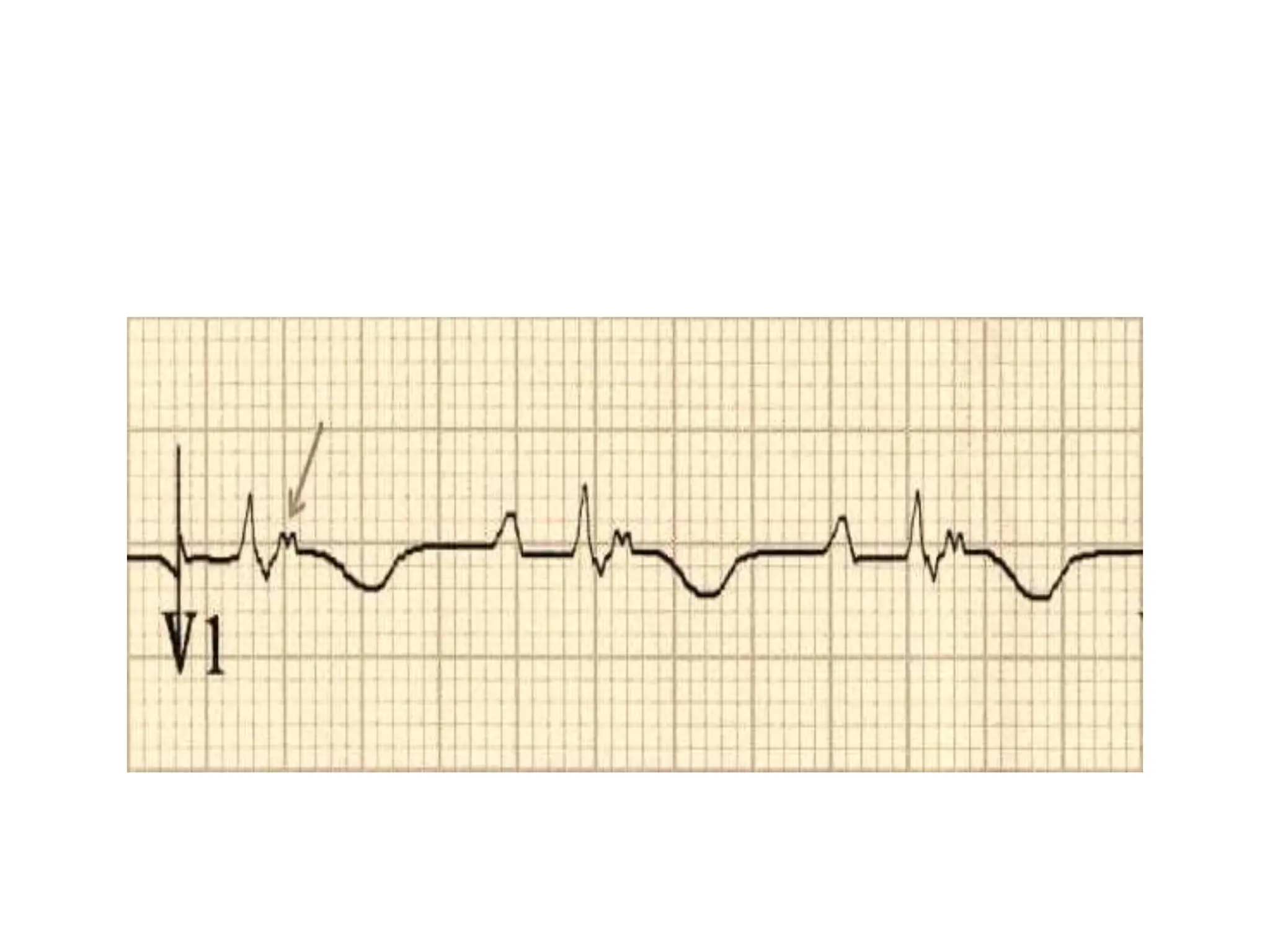 EPSILON WAVE IN ECG AND ITS INTERPRETATION | PPTX