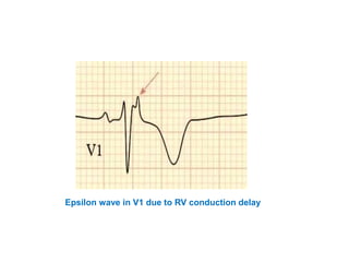 EPSILON WAVE IN ECG AND ITS INTERPRETATION | PPTX