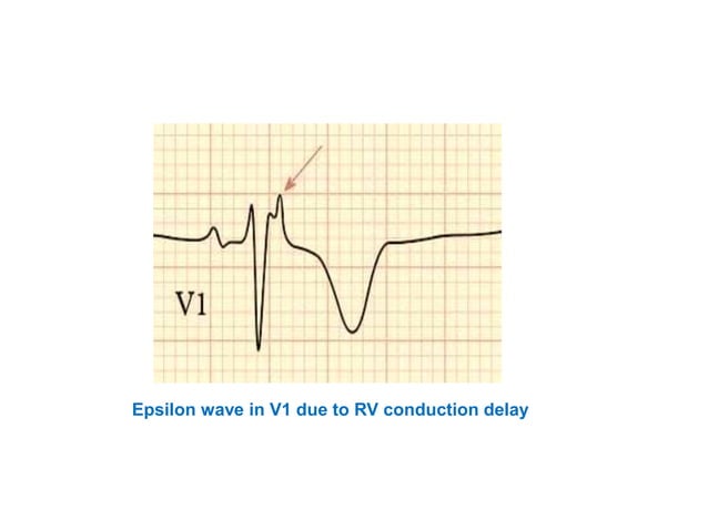 EPSILON WAVE IN ECG AND ITS INTERPRETATION | PPTX