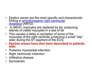 EPSILON WAVE IN ECG AND ITS INTERPRETATION | PPTX