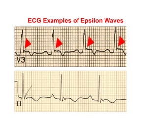 EPSILON WAVE IN ECG AND ITS INTERPRETATION | PPTX